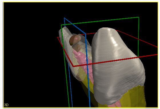 Creating Caries - Virteasy Dental updates